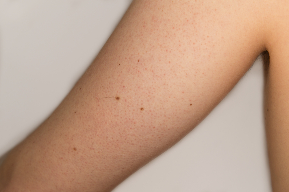How To Treat Keratosis Pilaris Aka ‘chicken Skin Ulike Der Blog